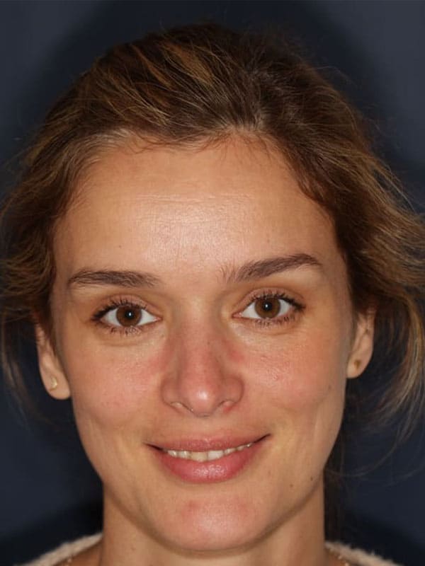 Before & After Cases | SLim Dental | Grand Central & Rockefeller Center ...